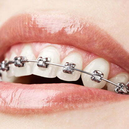 Are Metal Braces the Cheapest Braces for Kids? - Sky Dental: Phoenix ...