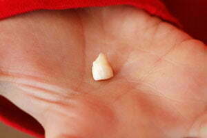 Why Do Adults Get a Loose Tooth? | Sky Dental AZ