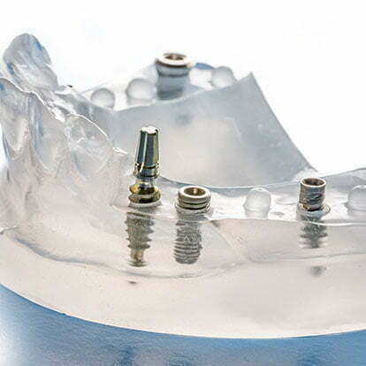 Dental Implants: The Next Best Thing After Your Real Teeth - SkydentalAZ