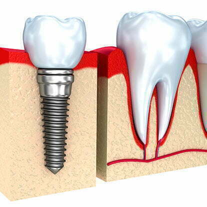 Essential Post-Operative Care for Dental Implant Surgery - SkydentalAZ