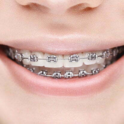 Got Braces? Keep these Things in Mind! - SkydentalAZ